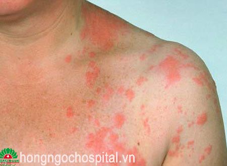 Luput ban đỏ hệ thống.
